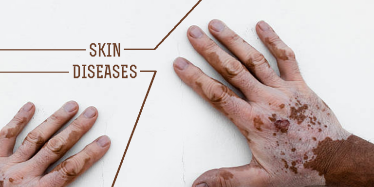 Skin disease type - Causes, Symptoms & Treatment