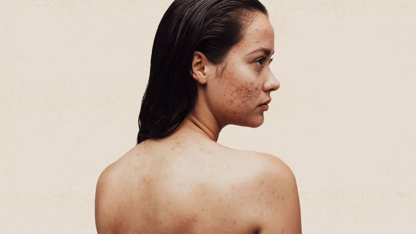 How To Get Rid Of Body Acne Once And For All - Isaac Luxe